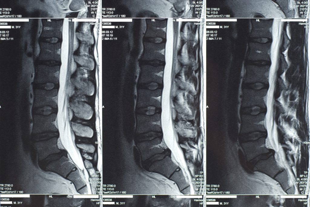 The Stages Of Herniated Disc Healing: Timeline and Details - Crush Back ...